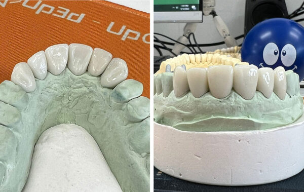 Provisional Crown Guide: Definition, Cement, and Final Steps
