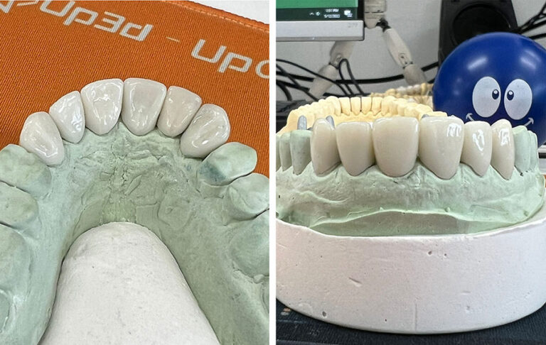 Provisional Crown Guide: Definition, Cement, and Final Steps