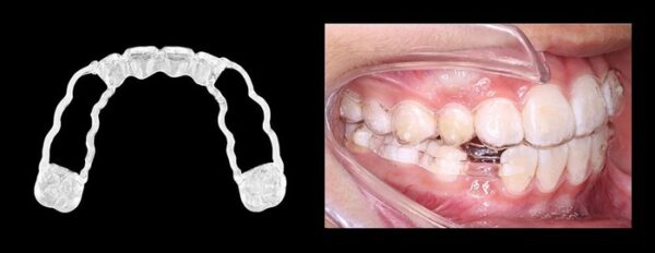 Orthodontic Innovation: Direct 3D Printing Aligners